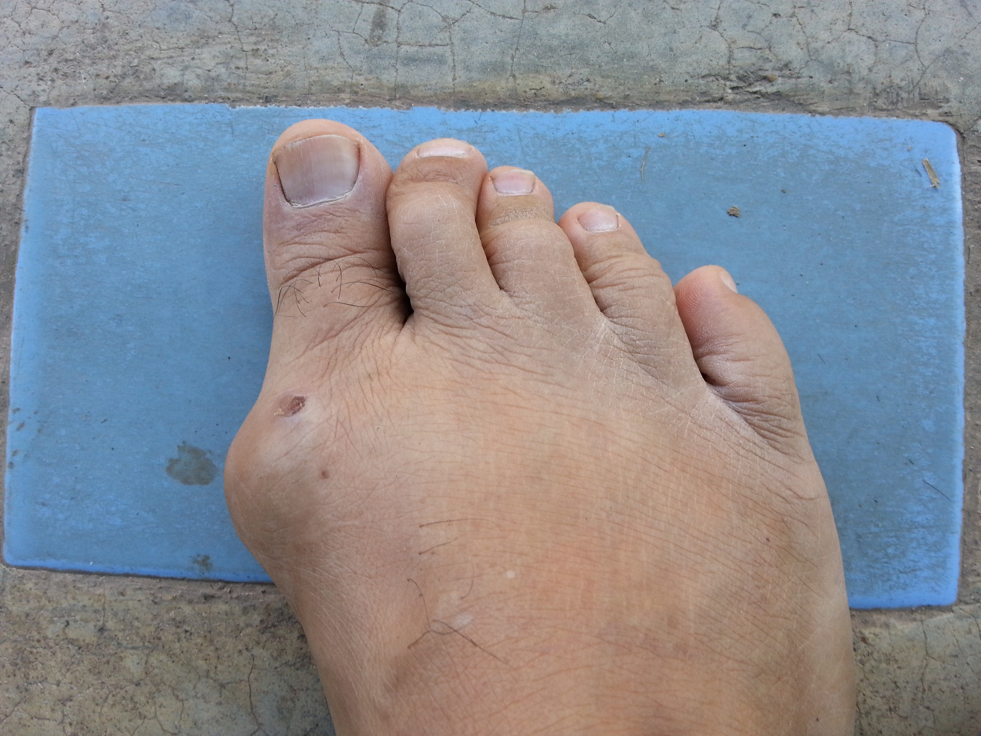 Gout- 5 things you need to know about gout today - Angyline EU Products ...